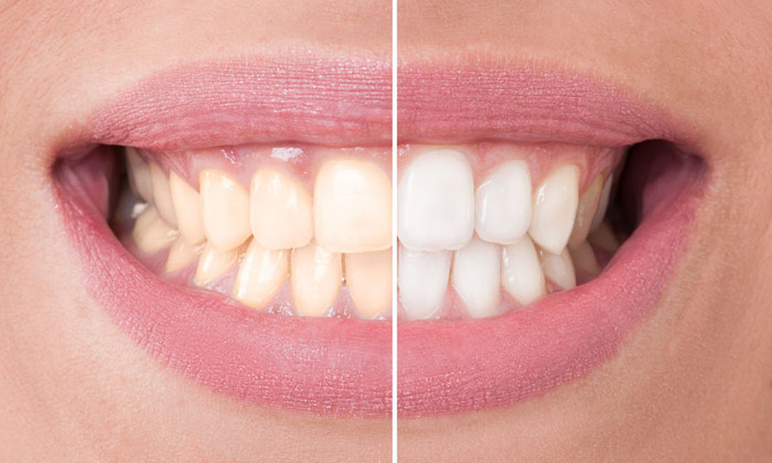 Is Teeth Whitening Harmful To Teeth - Edgecliff Dental Care